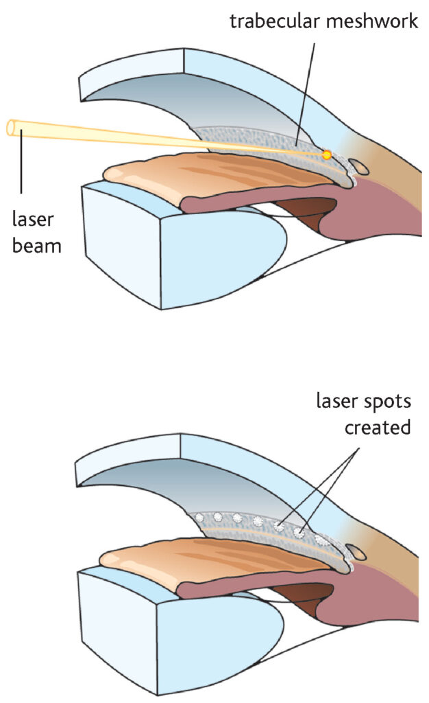 Argon Laser Trabeculoplasty — North Fulton Eye Center