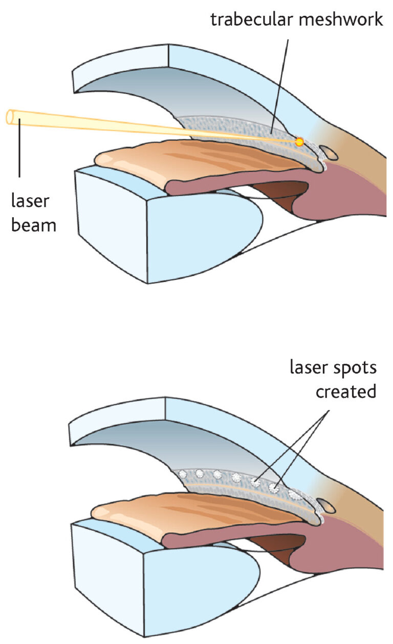 Argon Laser Trabeculoplasty — North Fulton Eye Center